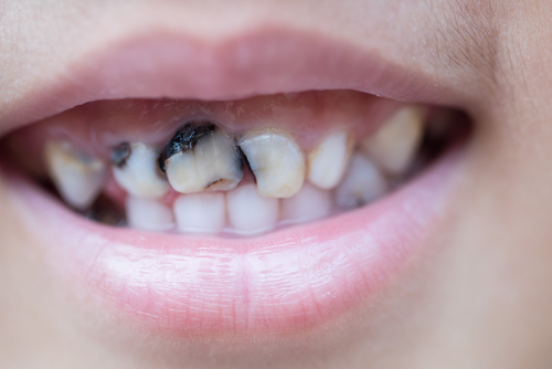 Why Do I Have Bad Breath? - Arise Dental